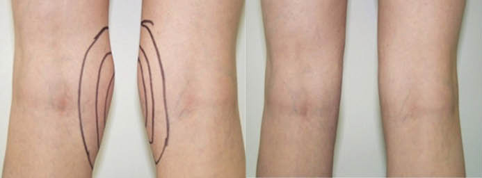 Fettabsaugen Bauch, Doppelkin und andere Körperteile